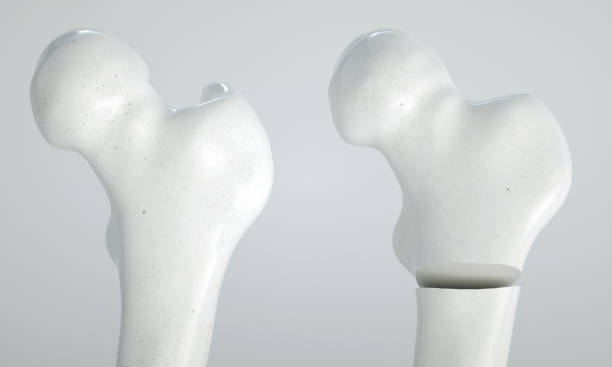 Cold Laser Therapy for Osteoporosis-Linked Fracture Healing – Pulse ...